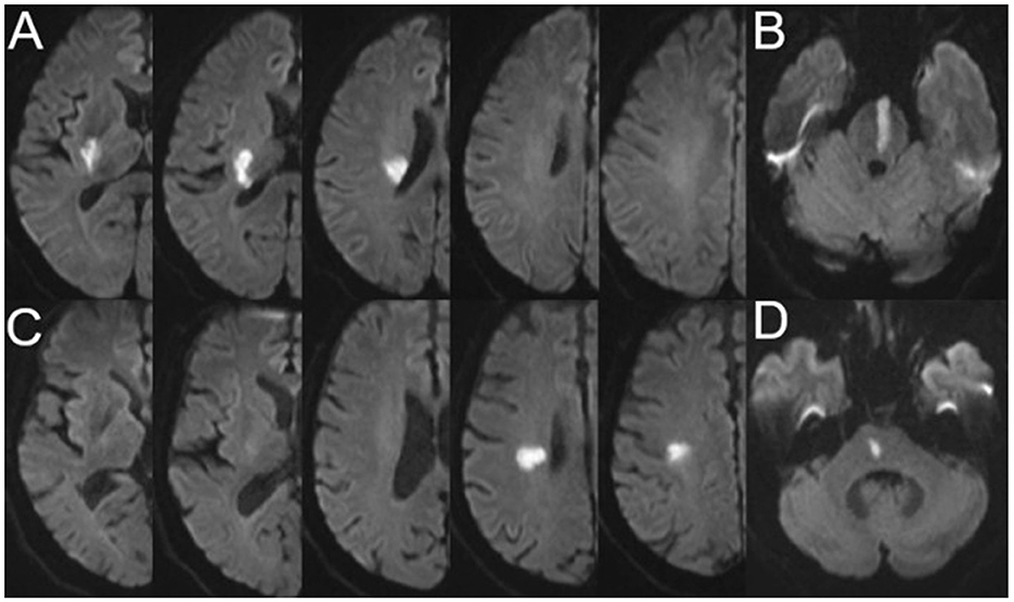Frontiers | Clinical factors associated with functional outcomes in ...