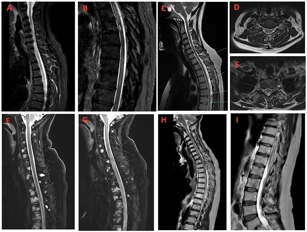 Frontiers | Case series: Immune checkpoint inhibitor-induced transverse ...