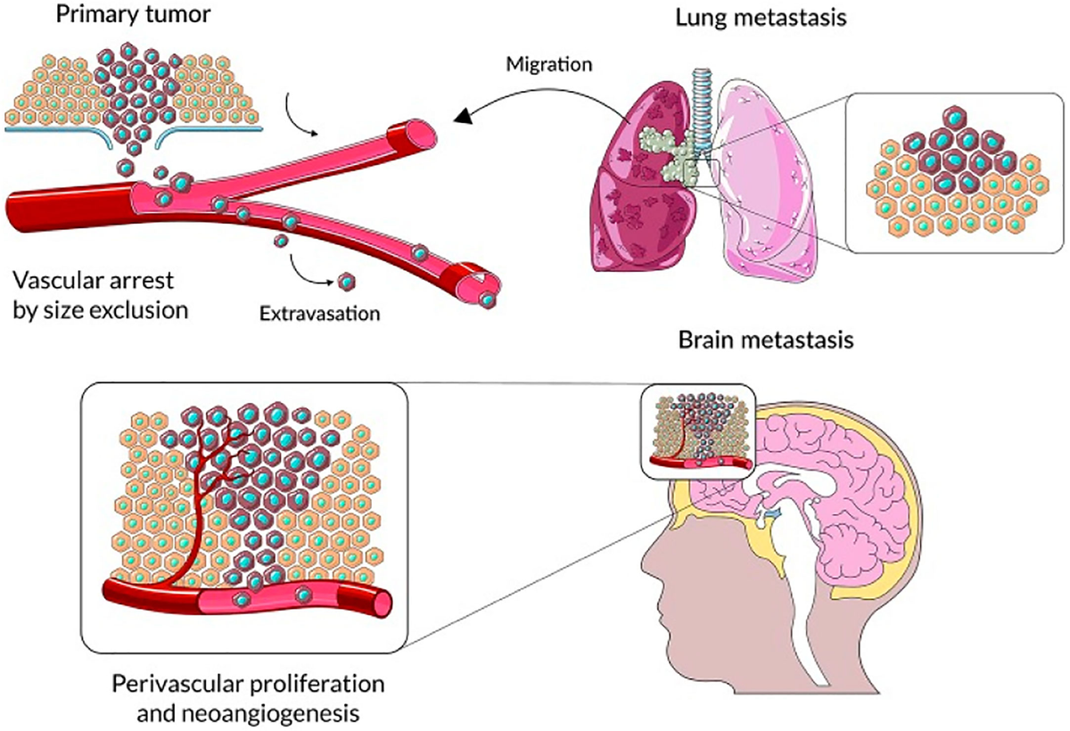 Frontiers | TME-targeted approaches of brain metastases and its clinical therapeutic evidence