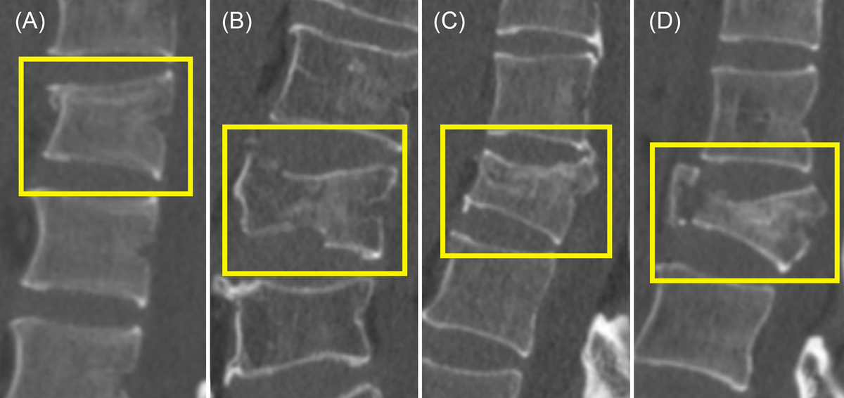 Frontiers | Automated detection and classification of acute vertebral ...