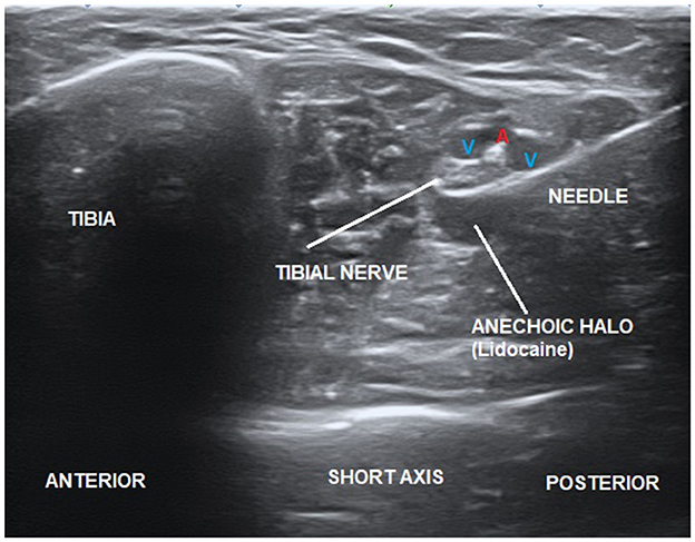 Frontiers | The role of ultrasound-guided perineural injection of the ...
