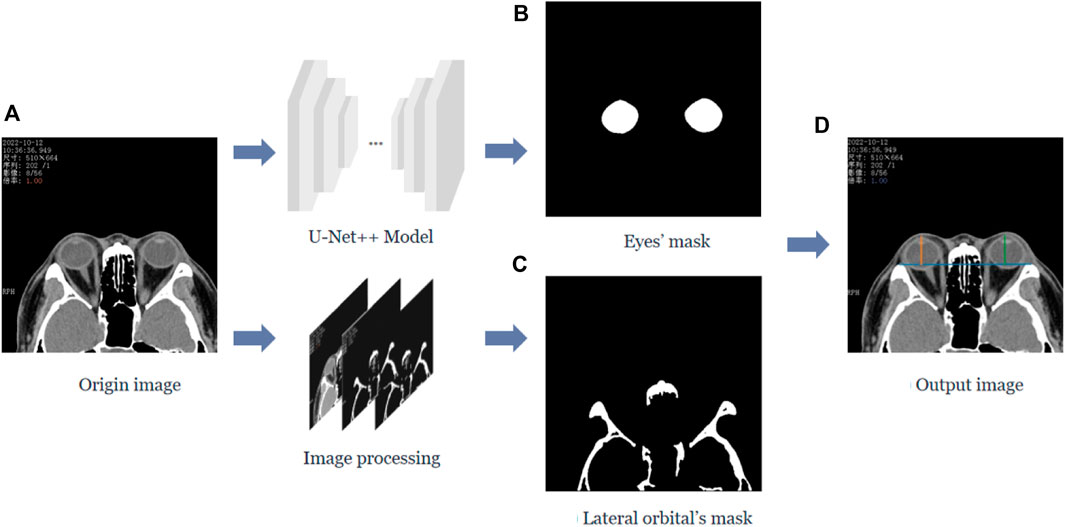 Exophthalmos Vs Proptosis