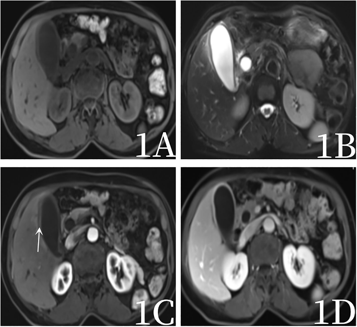 Frontiers | Application of 18F-FDG PET/CT imaging in gallbladder ...