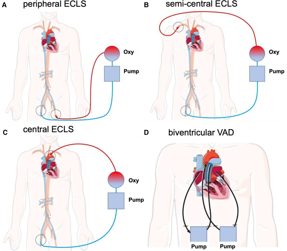 Frontiers | Central extracorporeal circulatory life support (cECLS) in ...
