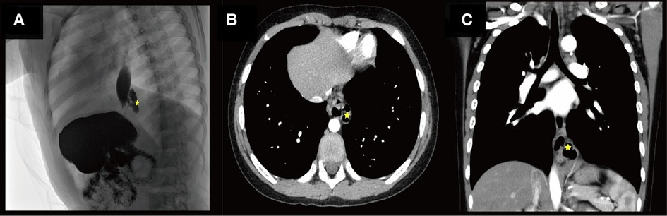 Frontiers Case Report Joint Diagnosis And Treatment Of Intrathoracic