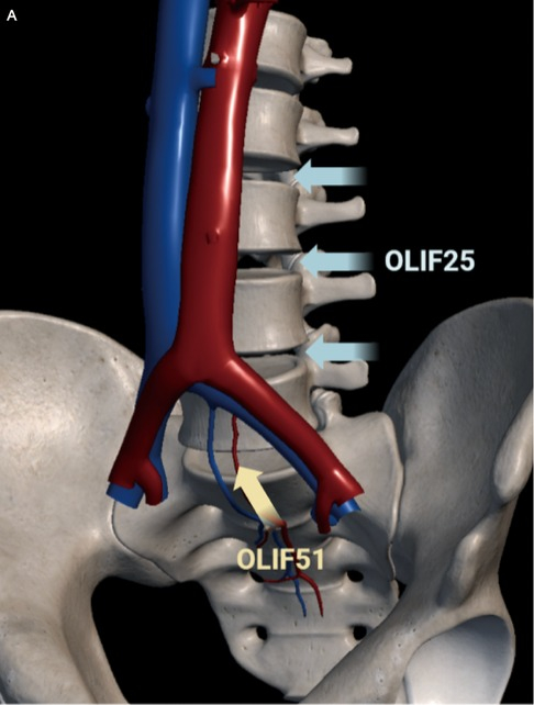 Frontiers | Application of the oblique lateral interbody fusion ...