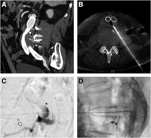 Frontiers Translumbar Type Ii Endoleak Embolization With A New Liquid