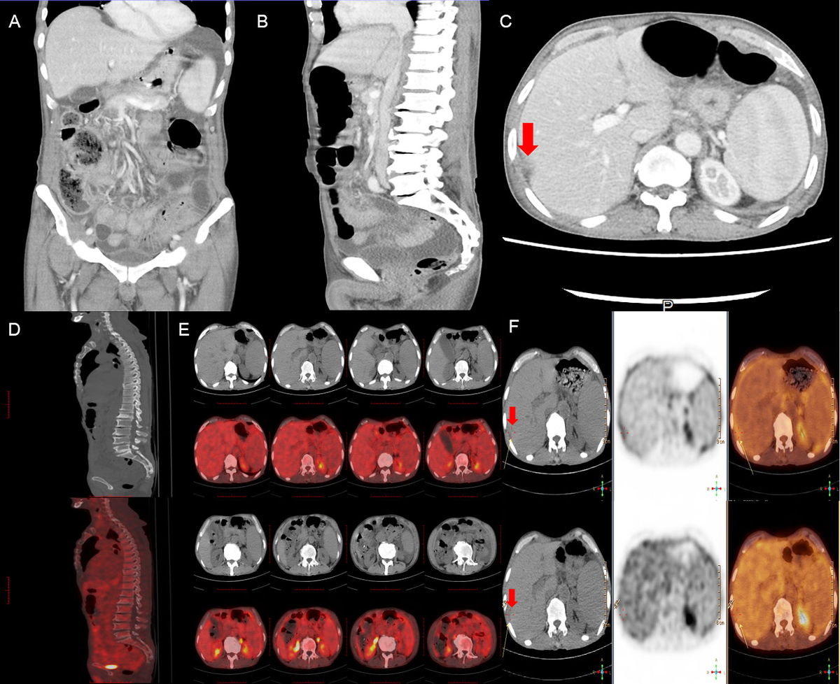 Frontiers | Fluid overload–associated large B-cell lymphoma with ...