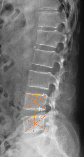 Frontiers | Radiological outcomes of PEEK rods in patients with lumbar ...