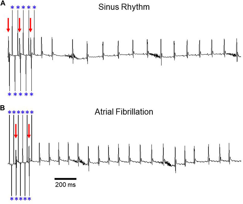 Frontiers | Overview of programmed electrical stimulation to assess ...