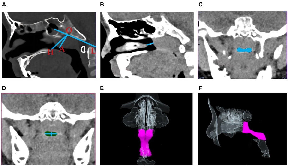 Frontiers | Diagnostic value of upper airway morphological data based ...