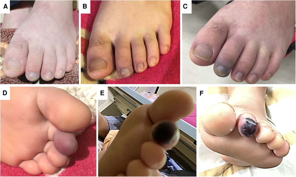 Frontiers | Case report: Endovascular treatment of acute limb ischemia ...