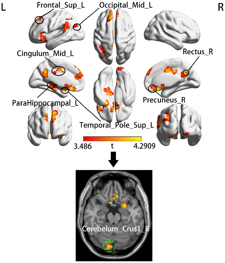 Frontiers | Relationship between temporal dynamics of intrinsic brain activity and motor ...