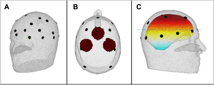 Frontiers | Towards continuous EIT monitoring for hemorrhagic stroke ...