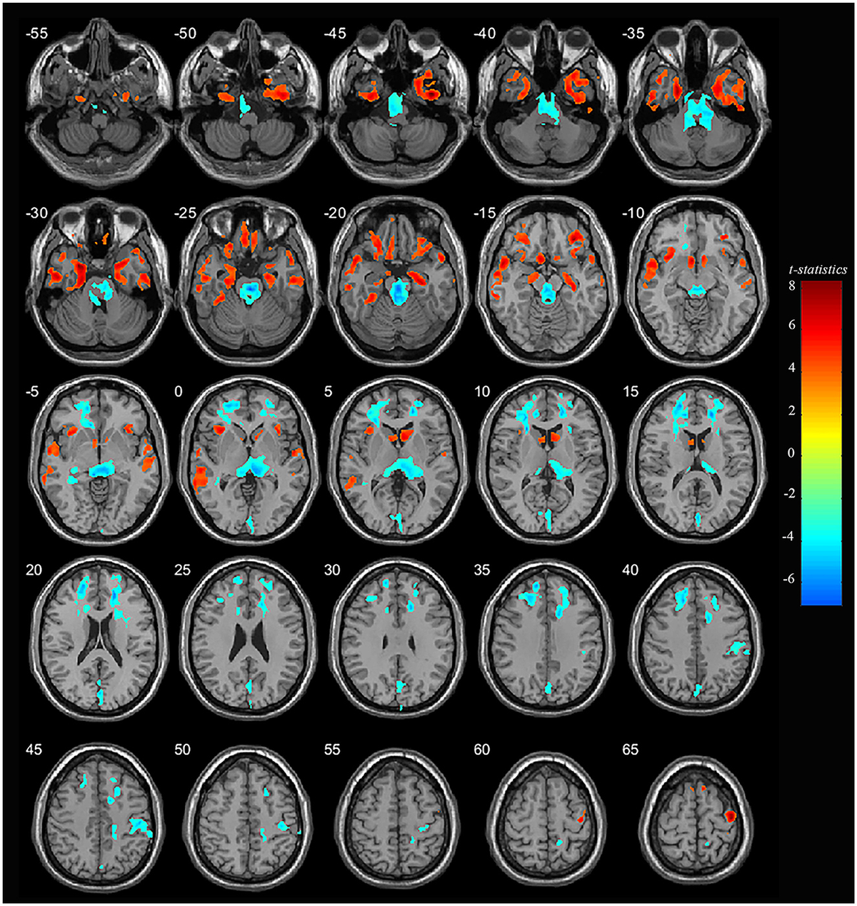 Frontiers | Severity related neuroanatomical and spontaneous functional ...
