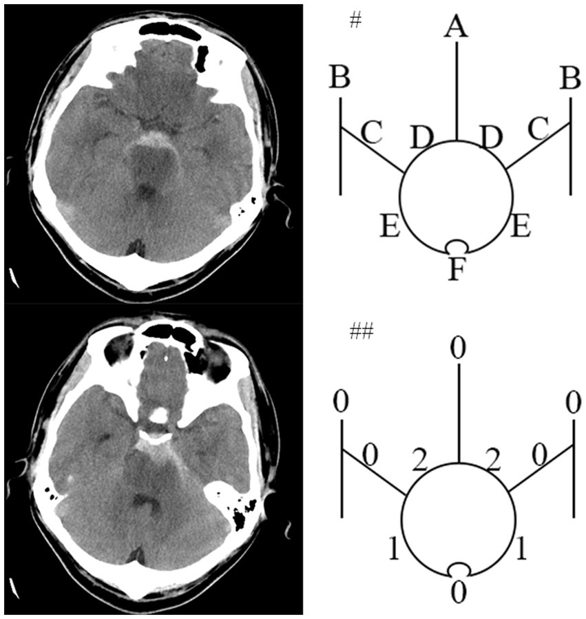 Frontiers | Clinical outcome and prognostic factors of patients with ...
