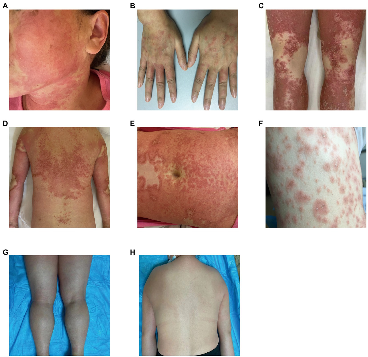 Frontiers | Clinical features of acute generalized exanthematous ...