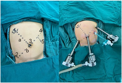 Frontiers | Robot-assisted resection of choledochal cyst in children
