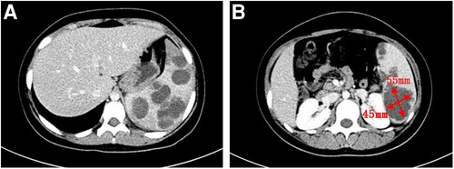 Frontiers | Case report: a case of multiple splenic abscesses in a ...