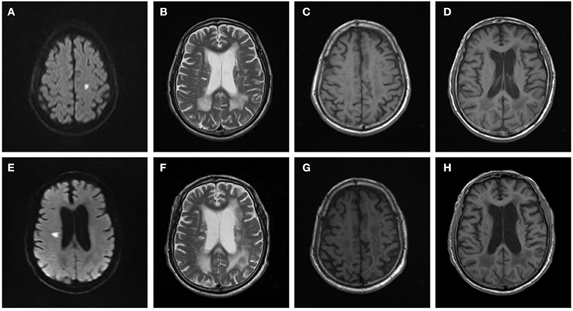 Frontiers | Arteriolosclerosis CSVD: a common cause of dementia and ...
