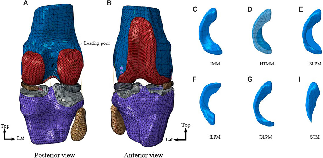 Frontiers | Biomechanical effects of the medial meniscus horizontal ...