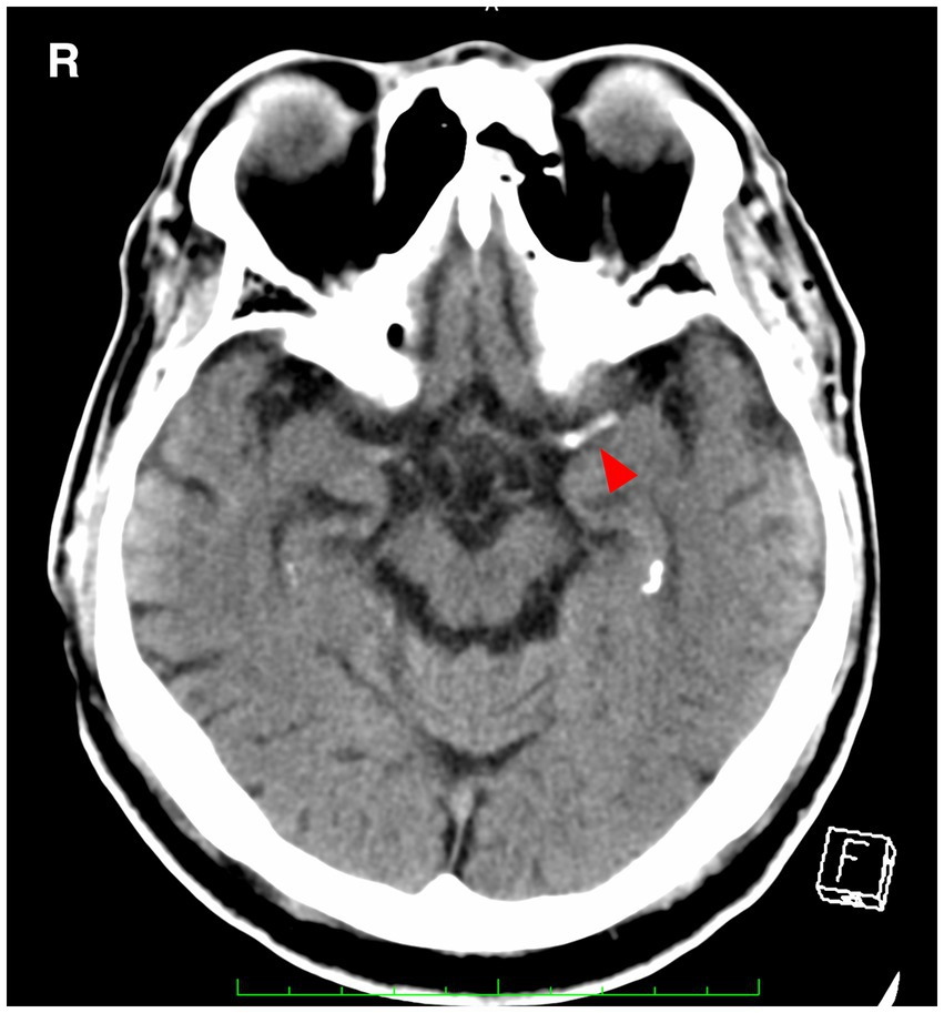 Frontiers | Imaging diagnosis of intracranial atherosclerosis stenosis ...