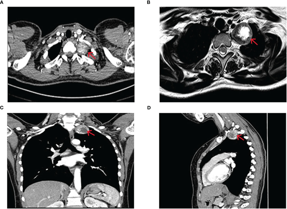 Frontiers | Case report: Combined cervical incision with an intercostal ...