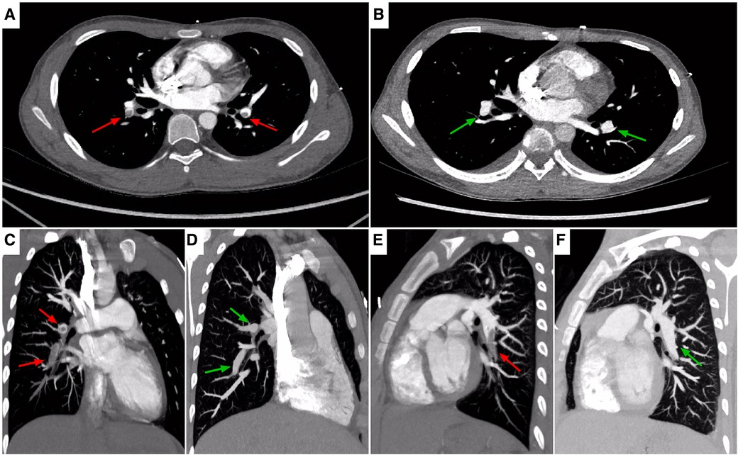 Frontiers | Case report: cerebral venous sinus thrombosis and pulmonary ...