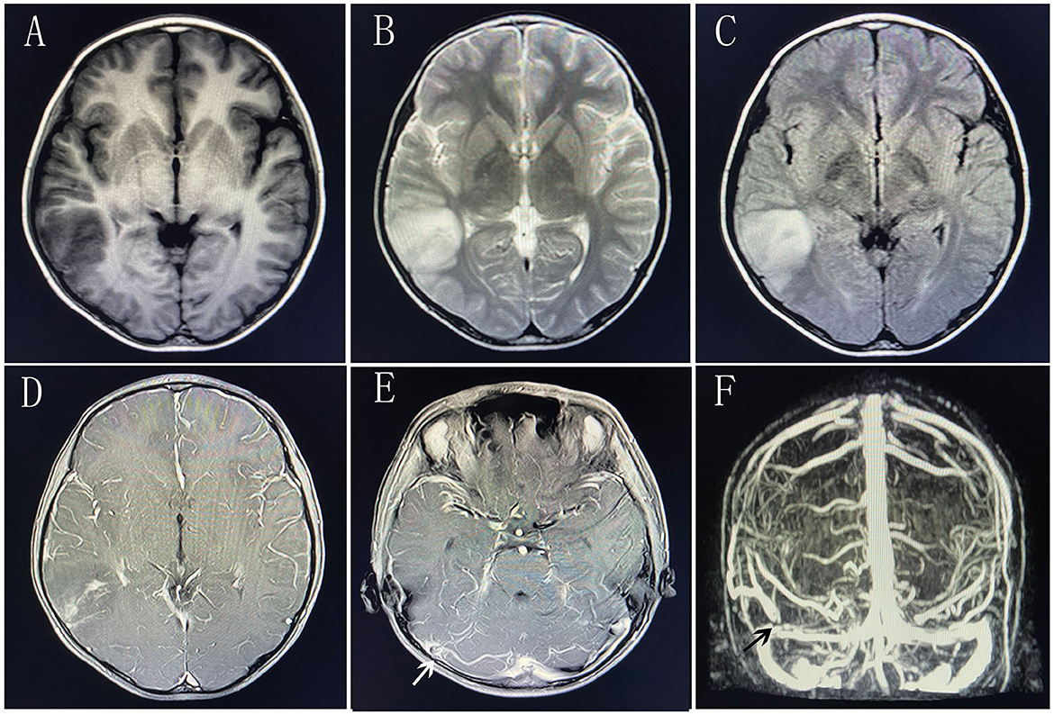Frontiers | Case report: Coexistence of Labbe vein thrombosis and ...