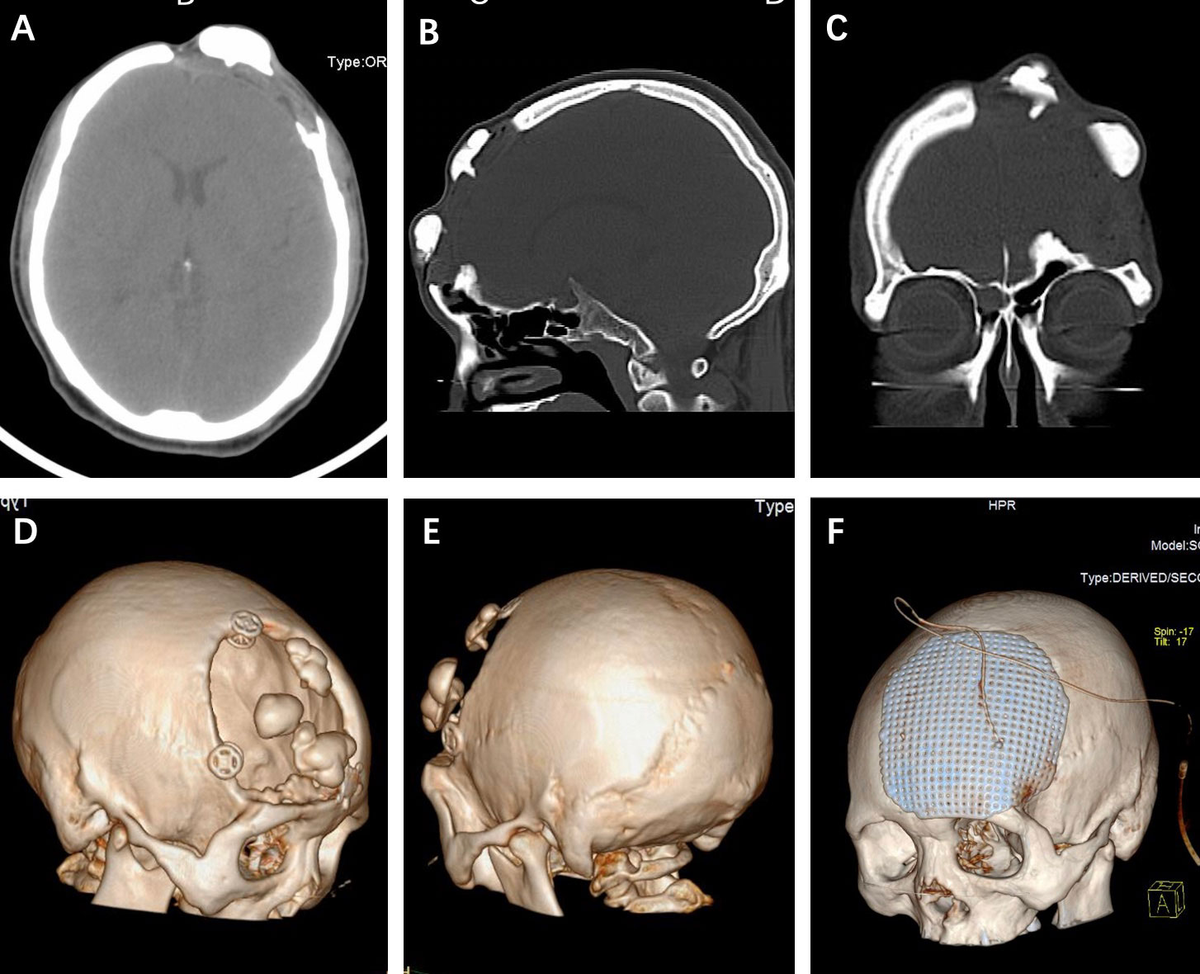 Frontiers | Relapse of skull osteoma after hydroxyapatite cement ...