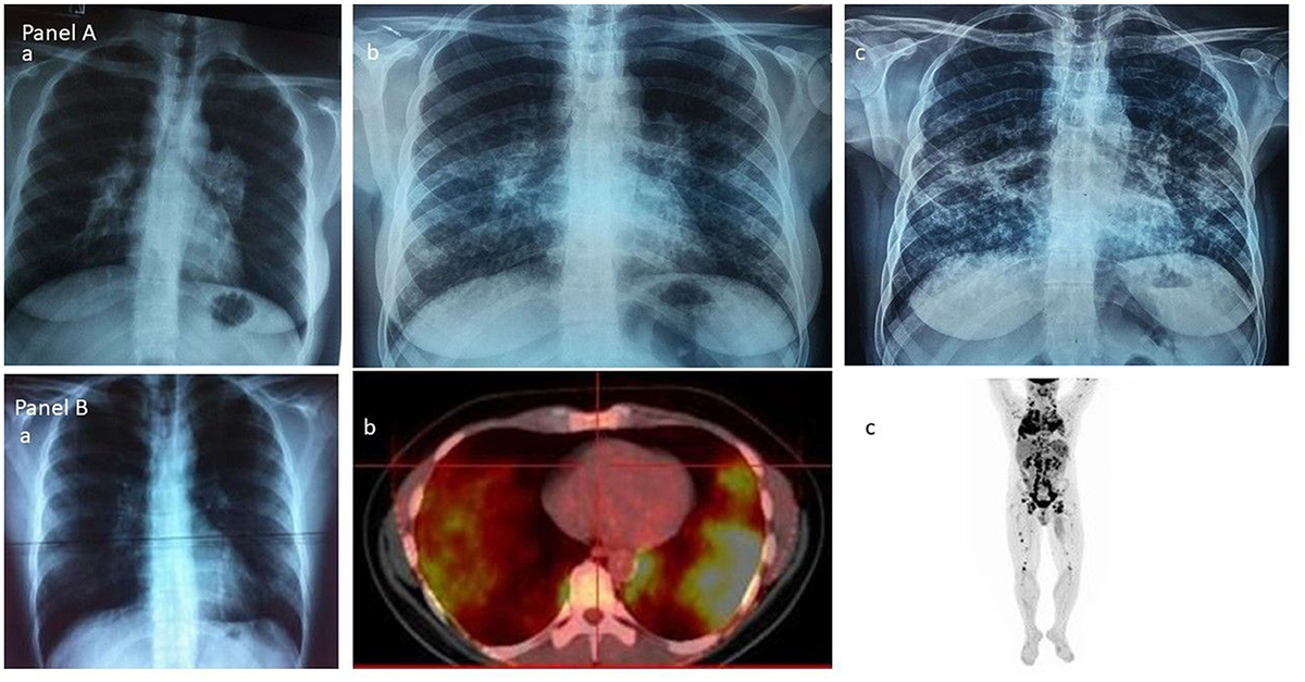 Frontiers | From Karl Wurm and Guy Scadding's staging to 18F-FDG PET/CT ...