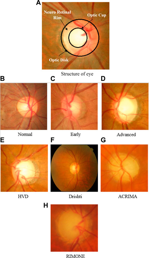 Frontiers | Multi-stage glaucoma classification using pre-trained convolutional neural networks ...