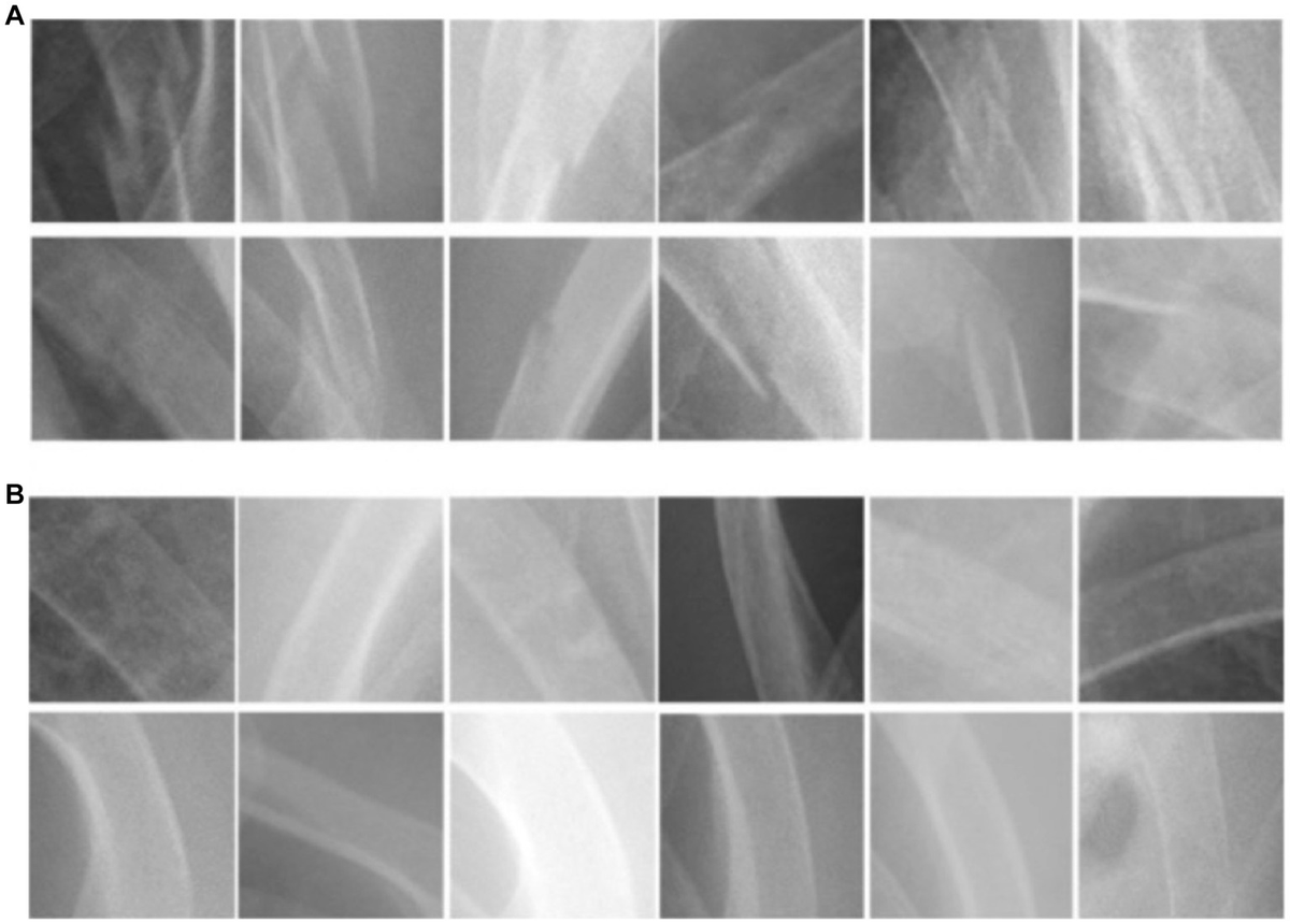 Frontiers | Deep convolutional neural network for rib fracture ...