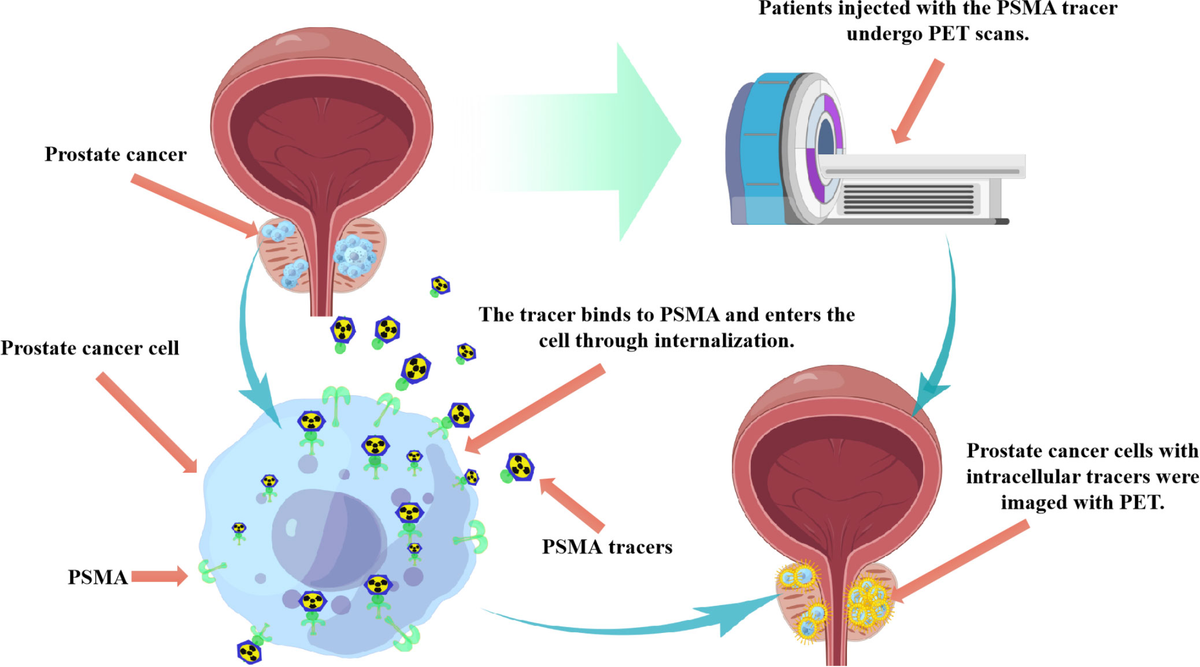 Frontiers | Application of targeted diagnosis of PSMA in the modality shift of prostate cancer ...