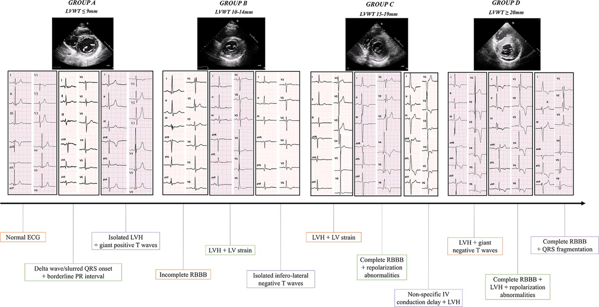 Frontiers | Electrocardiogram analysis in Anderson-Fabry disease: a ...