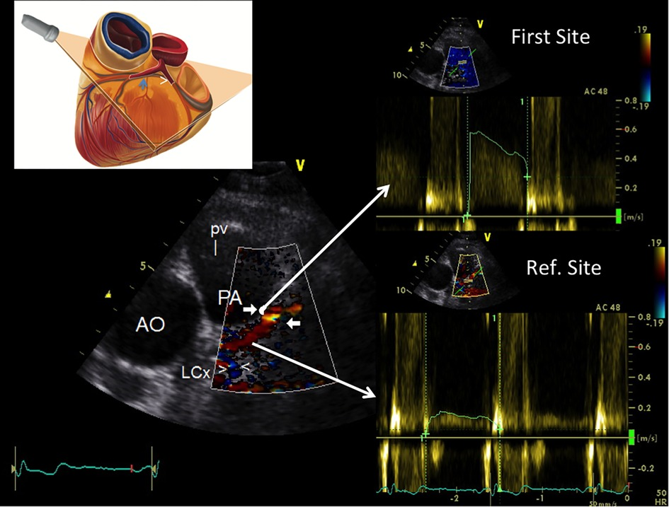 Frontiers | Accelerated stenotic flow in the left anterior descending ...