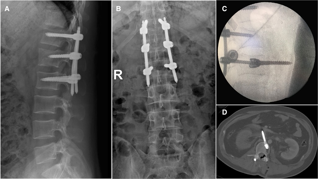 Frontiers | Severe major vessel injury during peadicle screw removal: a ...
