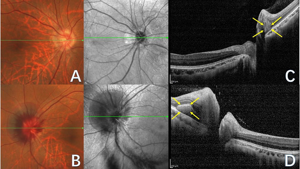 Frontiers | Peripapillary hyper-reflective ovoid mass-like structures ...