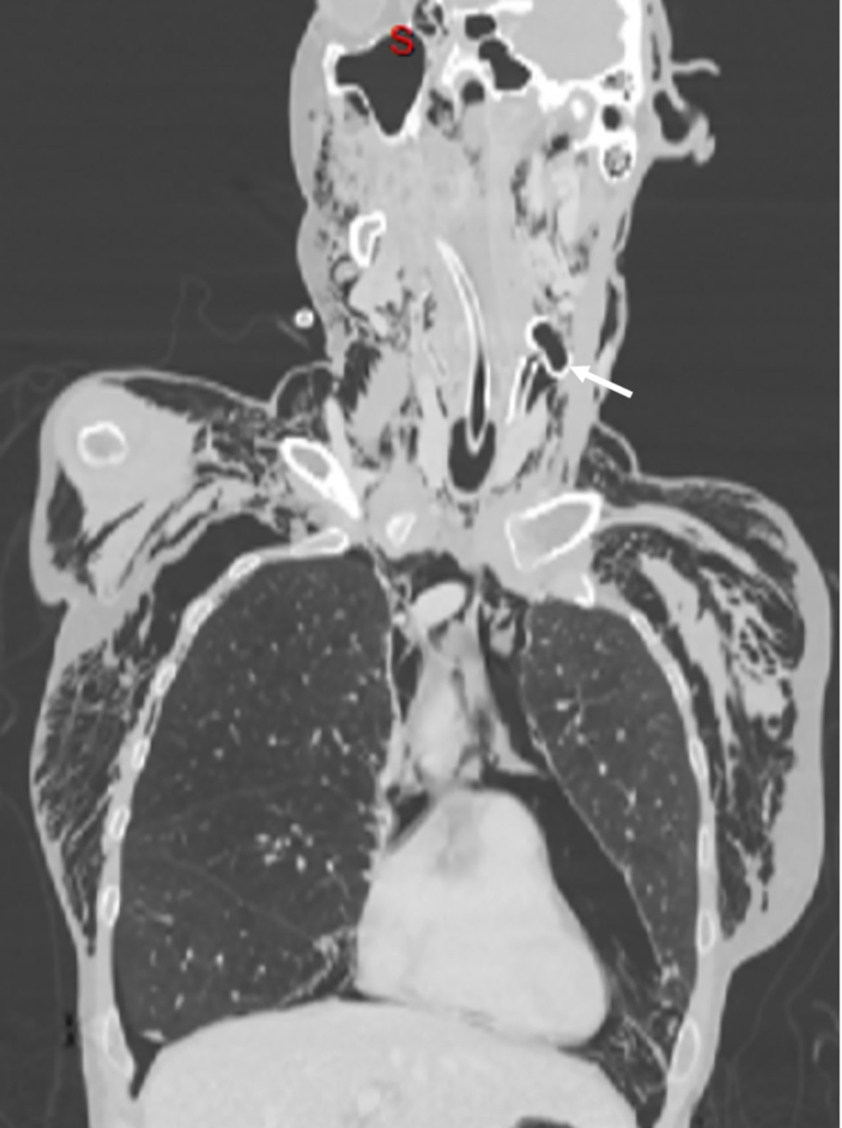 Frontiers | Severe respiratory distress secondary to pharyngeal ...