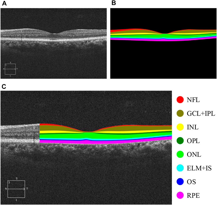 Frontiers | Exploiting multi-granularity visual features for retinal ...