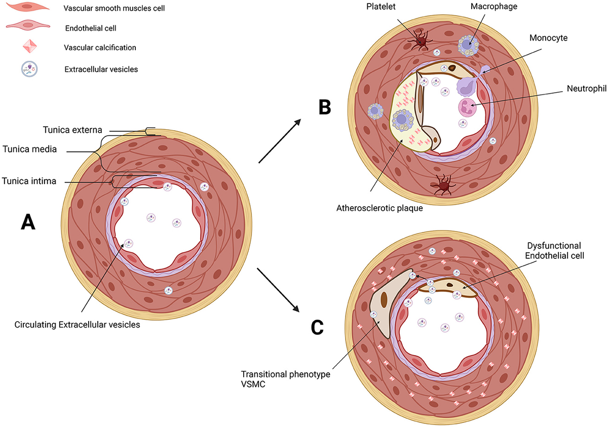 Frontiers | Extracellular vesicles in atherosclerosis and vascular calcification: the versatile ...