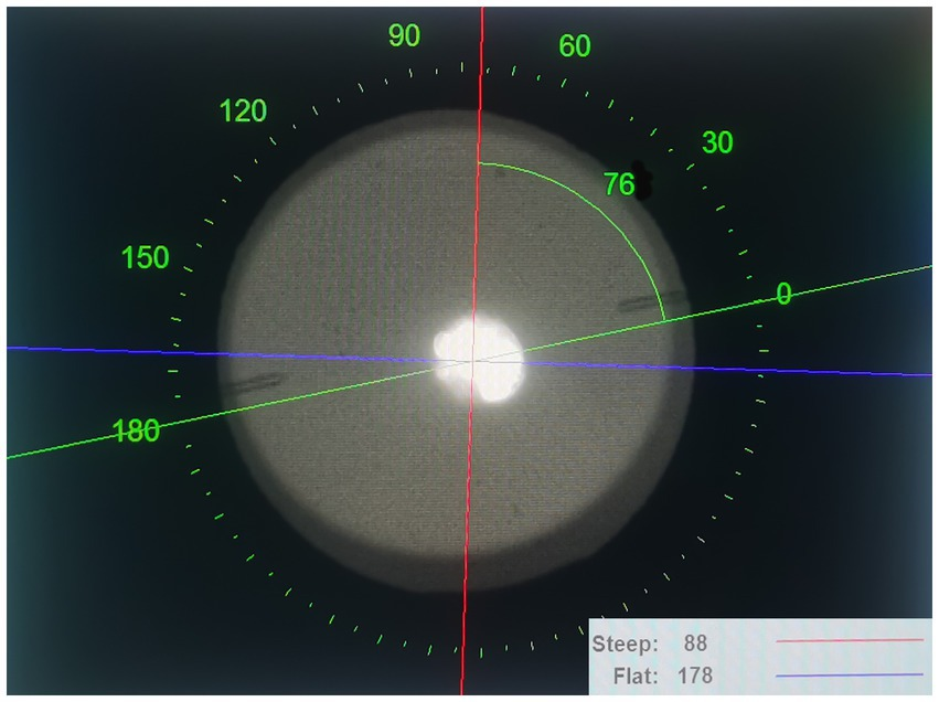 Frontiers | Effect of long-term rotation on astigmatism following EVO ...
