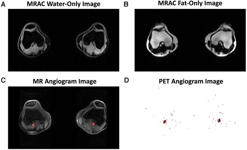 Frontiers | Effects of dynamic [18F]NaF PET scan duration on kinetic ...