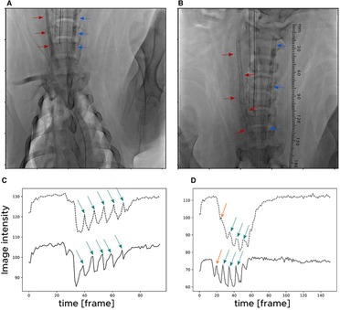 Frontiers | Effects of helical centerline stent vs. straight stent ...
