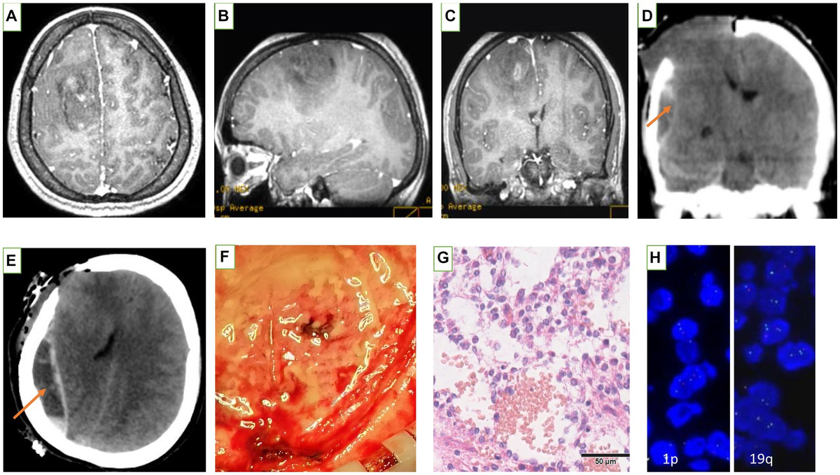 Frontiers | Case report: A rare case of cerebral herniation during ...