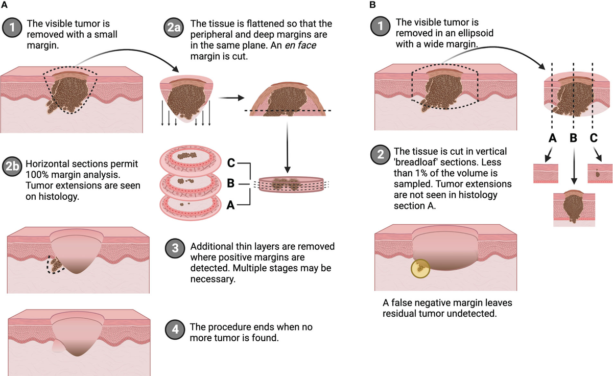 Frontiers | Paired-agent imaging as a rapid en face margin screening method in Mohs micrographic ...