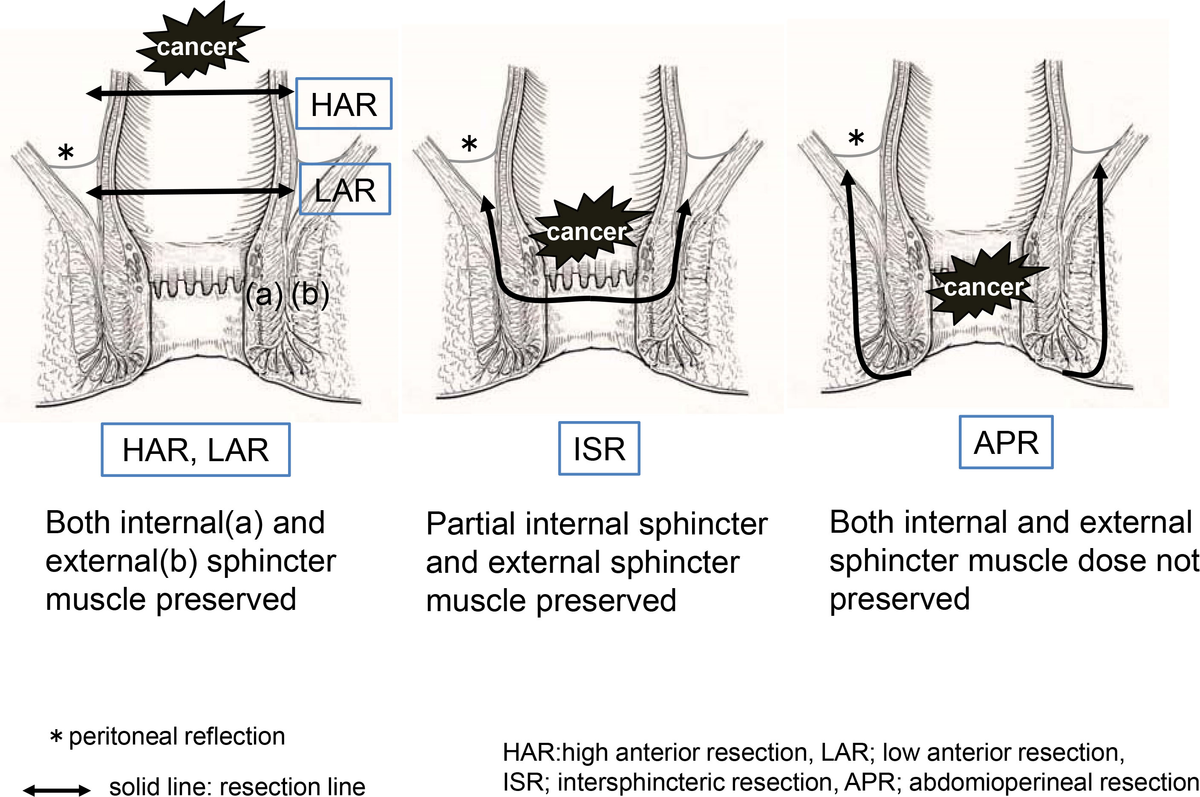 Frontiers | Comparison of long-term quality of life based on surgical ...