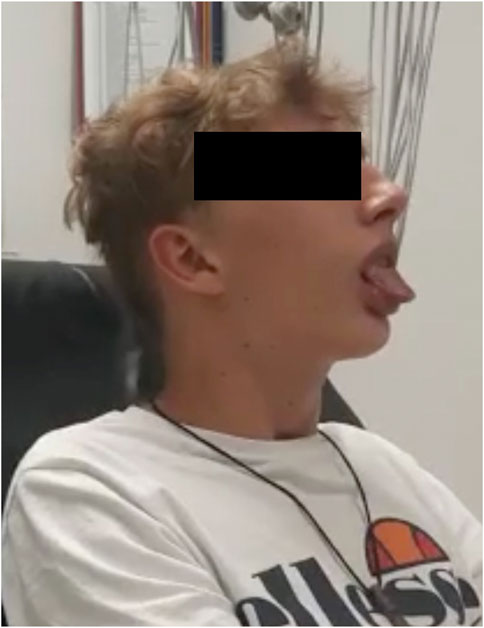 Frontiers | Case report: metoclopramide induced acute dystonic reaction ...