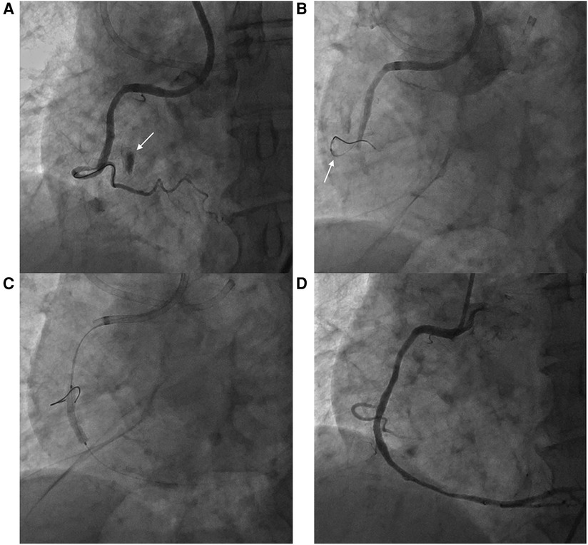 Frontiers | Case report: Constrictive pericarditis after coronary ...