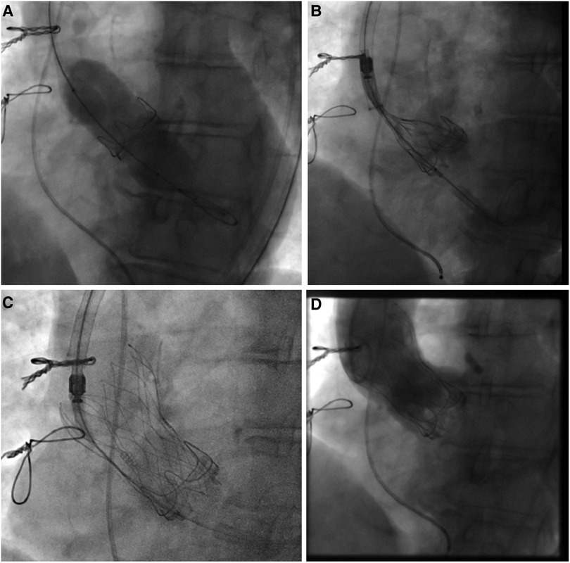 Frontiers | Valve-in-valve procedures for degenerated surgical and ...